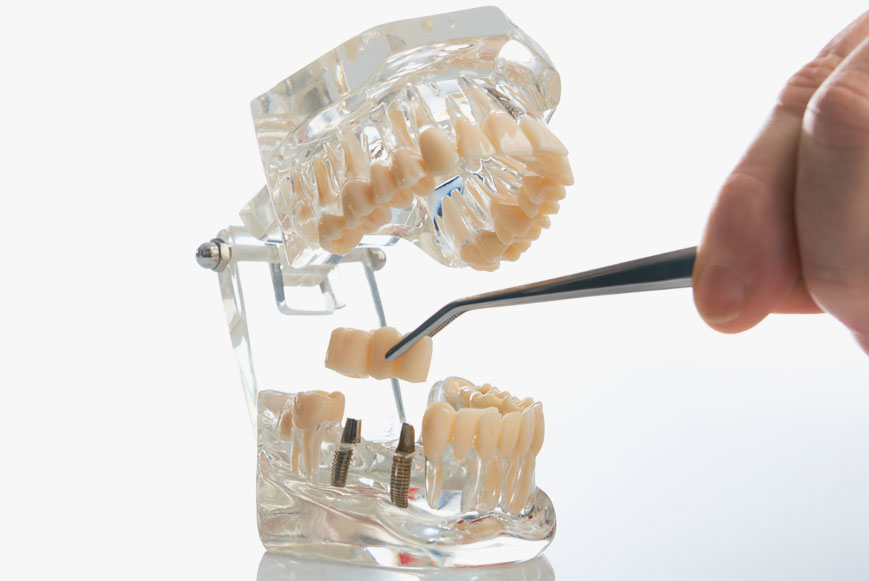 Crowns, Bridges and Veneers - All Dental West RydeAll Dental West Ryde